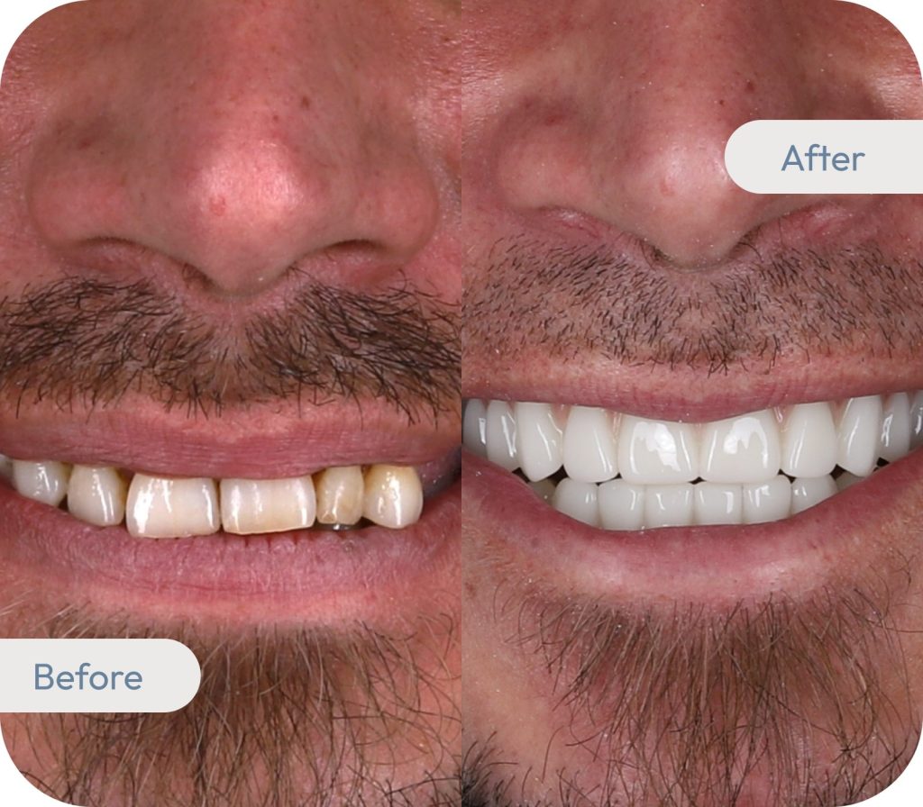 Smile Gallery | Real Results from Real Eversmile Dental Patients